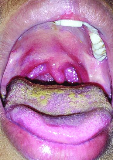 Uvula Is Deviated To The Left Side On Admission Download Scientific