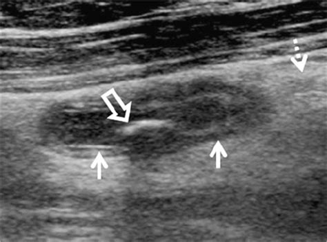 Carcinoid Of The Appendix In A Year Old Girl With Day Of Right Download Scientific Diagram
