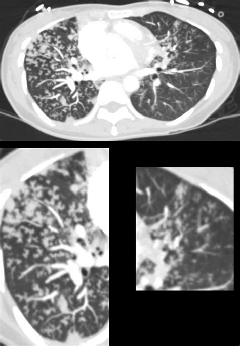 Faces Of Tree In Bud The Common Vein