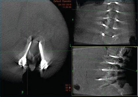 Imaging In Lumbar Spine Surgery The Role Of Intraoperative Ct Scan Musculoskeletal Key