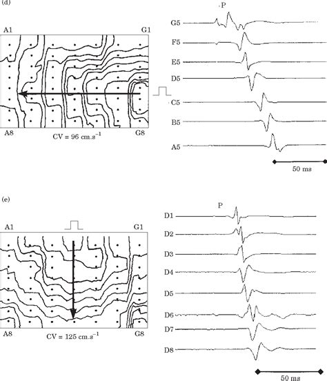 Figure 2 From Right Atrial Free Wall Conduction Velocity And Degree Of Anisotropy In Patients