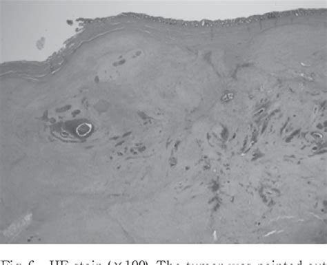 Figure 6 From A Case Of Rectal Gist Performed By Laparoscopic Super Low Anterior Resection With