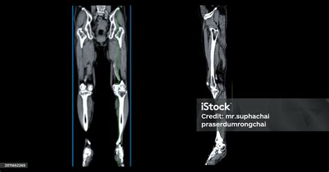 A Ct Venogram Of The Leg Is A Noninvasive Imaging Procedure Offering