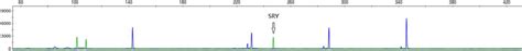 The Electrophoretogram Of Sex Chromosomes Of The Patient Specific SRY Download Scientific