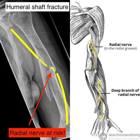 Humerus Radial Nerve Anatomy