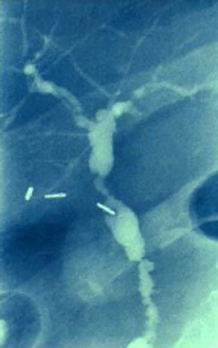 Primary Sclerosing Cholangitis Flashcards Quizlet