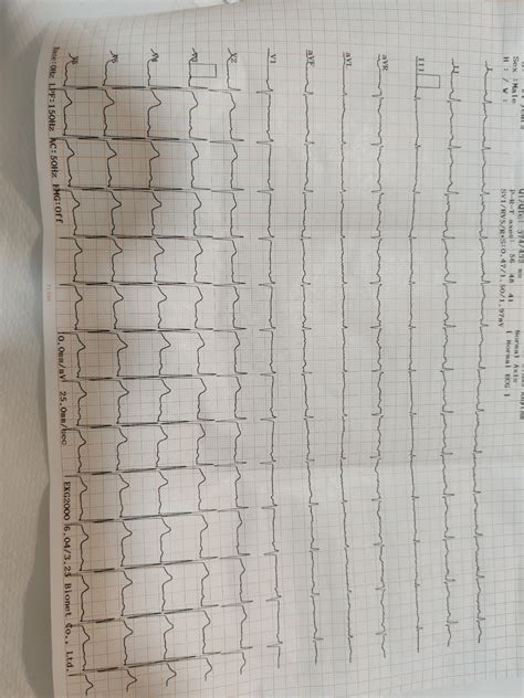 Is This Ecg Normal R Askmedical
