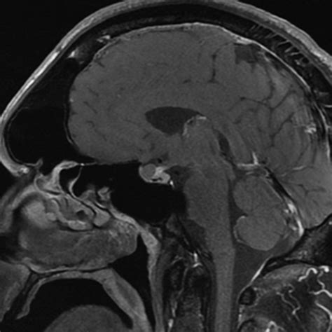 Pituitary Tumor Picture Of Pituitary Tumor