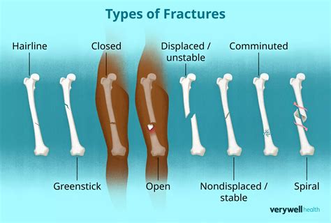 Injury Settlements For Fractures Crush Injuries And Dislocations