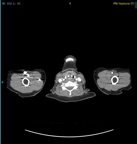 ohif v3 add image overlay in viewport · issue 3144 · ohif viewers