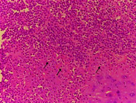 Chondroid Type Matrix With Chicken Wire Calcification Arrow He ×20