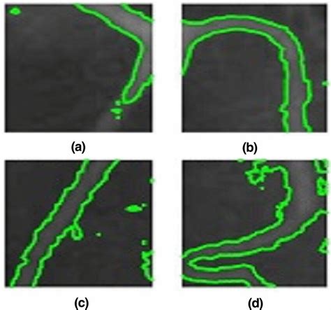 Segmentation Of Fig 3ad Using The Proposed Method After 100