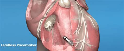 Leadless Pacemaker Wireless Heart Rytm Solution