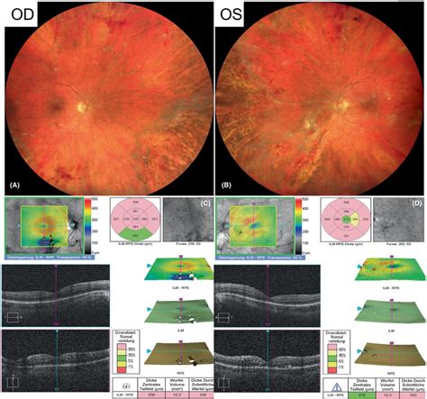 Fundus Photos With The Corresponding Octs Almost Two Months After Download Scientific Diagram