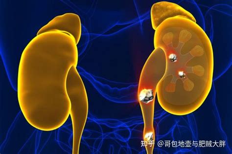 肾小管酸中毒为什么我会患上肾小管酸中毒三 知乎