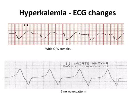 Hypokelemia And Hyperkelemia Pptx