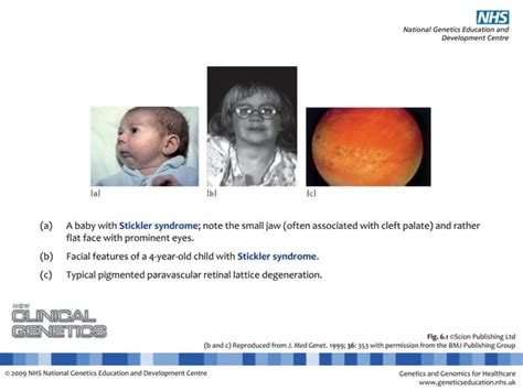 Clinical Photos Autosomal Dominant Conditions Ppt