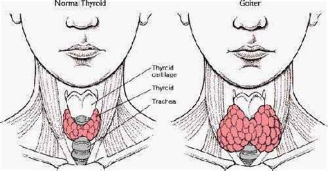 Goitre Enlarged Thyroid Gland Classes Causes Signs And Symptoms