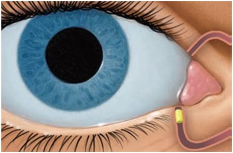 Full Article Effects Of Punctal Occlusion On Ocular Itching And Conjunctival Redness Associated Full Article Effects Of Punctal Occlusion On Ocular Itching And Conjunctival Redness Associated