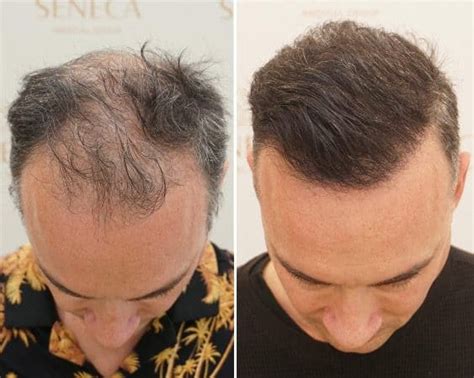 Θεραπείες Τριχόπτωσης με Μινοξιδίλη And Φιναστερίδη Seneca