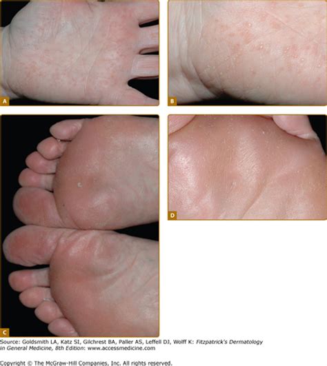 Inherited Palmoplantar Keratodermas Plastic Surgery Key