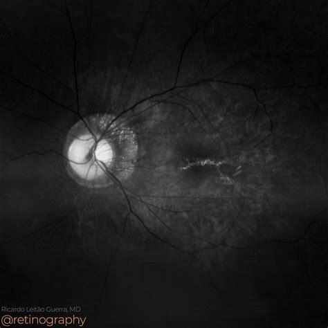Degenerative Myopia Lacker Cracks Retinography