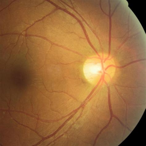 Glaucoma Object Detection Dataset By Glaucoma
