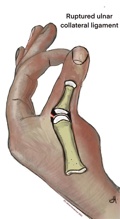 Ruptured Ulnar Collateral Ligament Of The Thumb Metacarpophalangeal Joint Skiers Thumb James