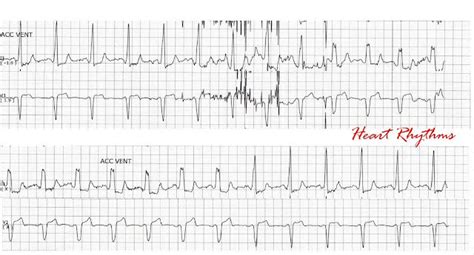 Ecg Rhythms Rate Dependent Left Bundle Branch Block
