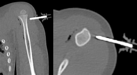 3 Year Old Female Following Road Traf Fi C Accident Pmct Shows