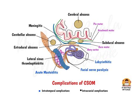 Complications Of Csom From Hearing Loss To Life Threatening Risks