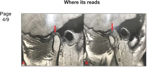 Scielo Brazil Temporomandibular Joint Disc Displacement With