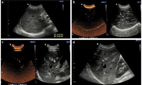 A Mildly Hyperechoic Solid Mass In Segment 7 Of The Liver B Mode B