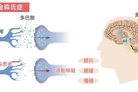 Parkinson S Disease