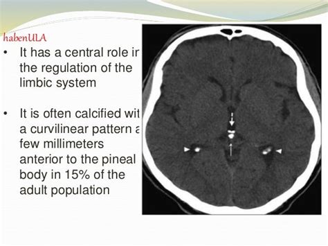 Physiological And Pathological Calcification Of Brain