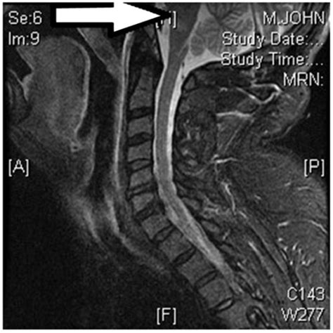 Cervical Spine Abnormal X Ray Bbdolf