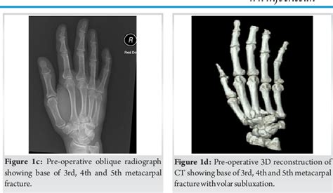 Figure 1 From An Uncommon Presentation Of Fracture Dislocation Of The 4th And 5th