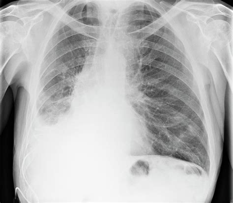 Pleural Effusion X Ray Lung Cancer With Pleural Effusion X Ray Hot Sex Picture