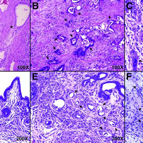 Comparison Of Human And Mouse Pdac Lesions A C Human Pdac Exhibits A