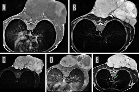 Chest Mri Order At Kelley Nichols Blog