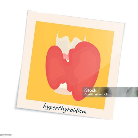 사진 프레임에서 Hyperthyroid 선 갑상샘에 대한 스톡 벡터 아트 및 기타 이미지 갑상샘 갑상샘기능 항진증 갑상샘종 Istock