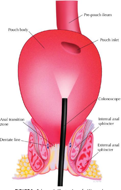 Figure 2 From Guide To Endoscopy Of The Ileo‐anal Pouch Following