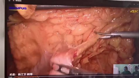 David Zhang On Linkedin Laparoscope Assisted Radical Gastrectomy For