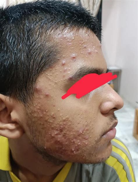 7 Months Journey R Tretinoin