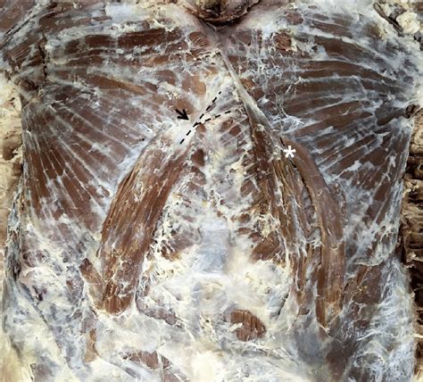 Photograph Of The Described Bilateral Sternalis Muscle The Right