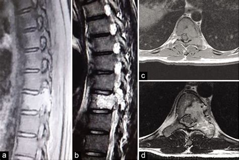 Aneurysmal Bone Cyst Mri