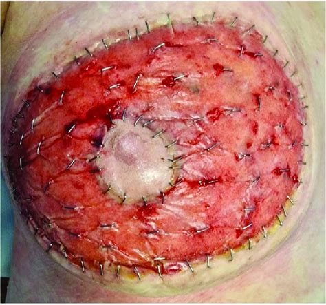 Pyoderma Gangrenosum Right Breast After Matrix Application Download