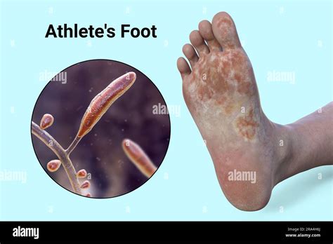 Bullous Tinea Pedis