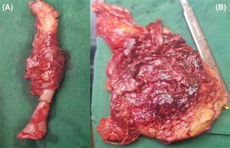 A Appendix B Fibrofatty Tissue With Severe Inflammation