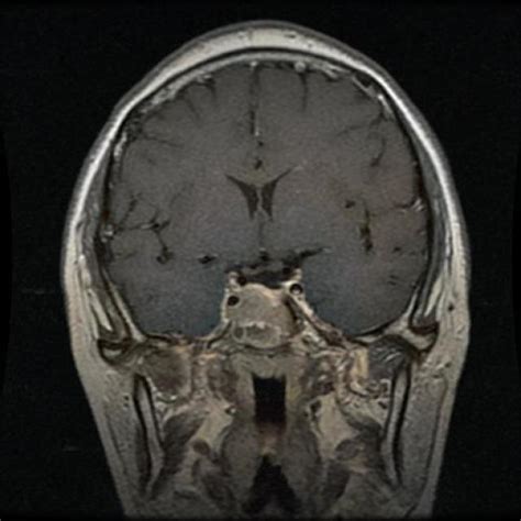 Tumor Detection Object Detection Dataset V8 2024 07 31 2 19pm By
